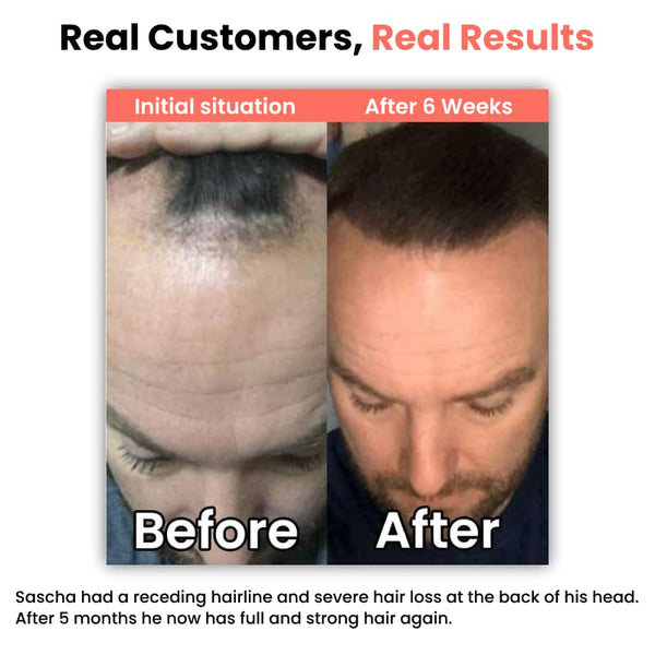 HeyRestore Laser Hair Regrowth Devices | FDA-Cleared Hair Restore
